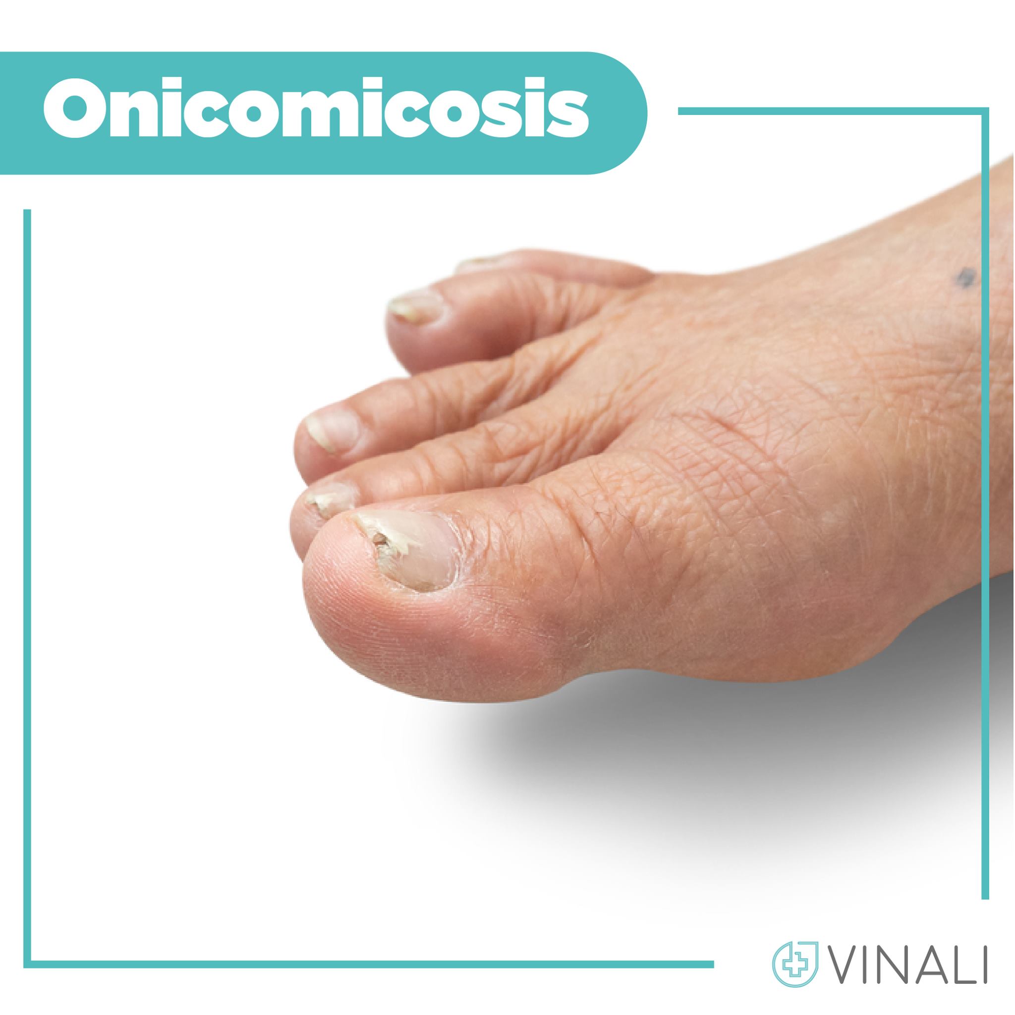 Onicomicosis | Tratamiento para onicomicosis | Vinali